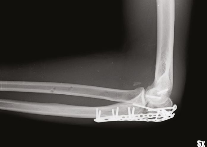 Comminuted olecranon and capitulum humeri fracture